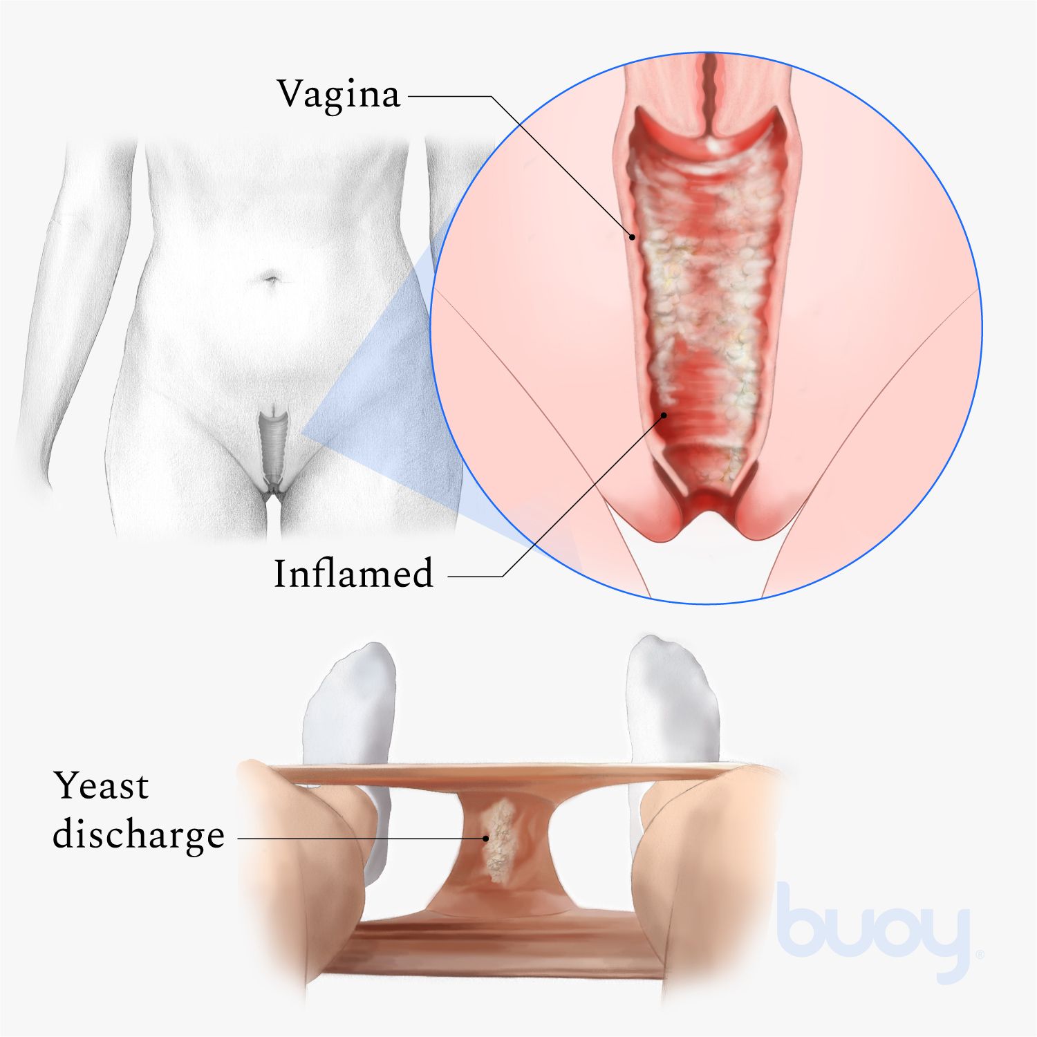 Yeast Infection Diagnosis Treatment Options Buoy
