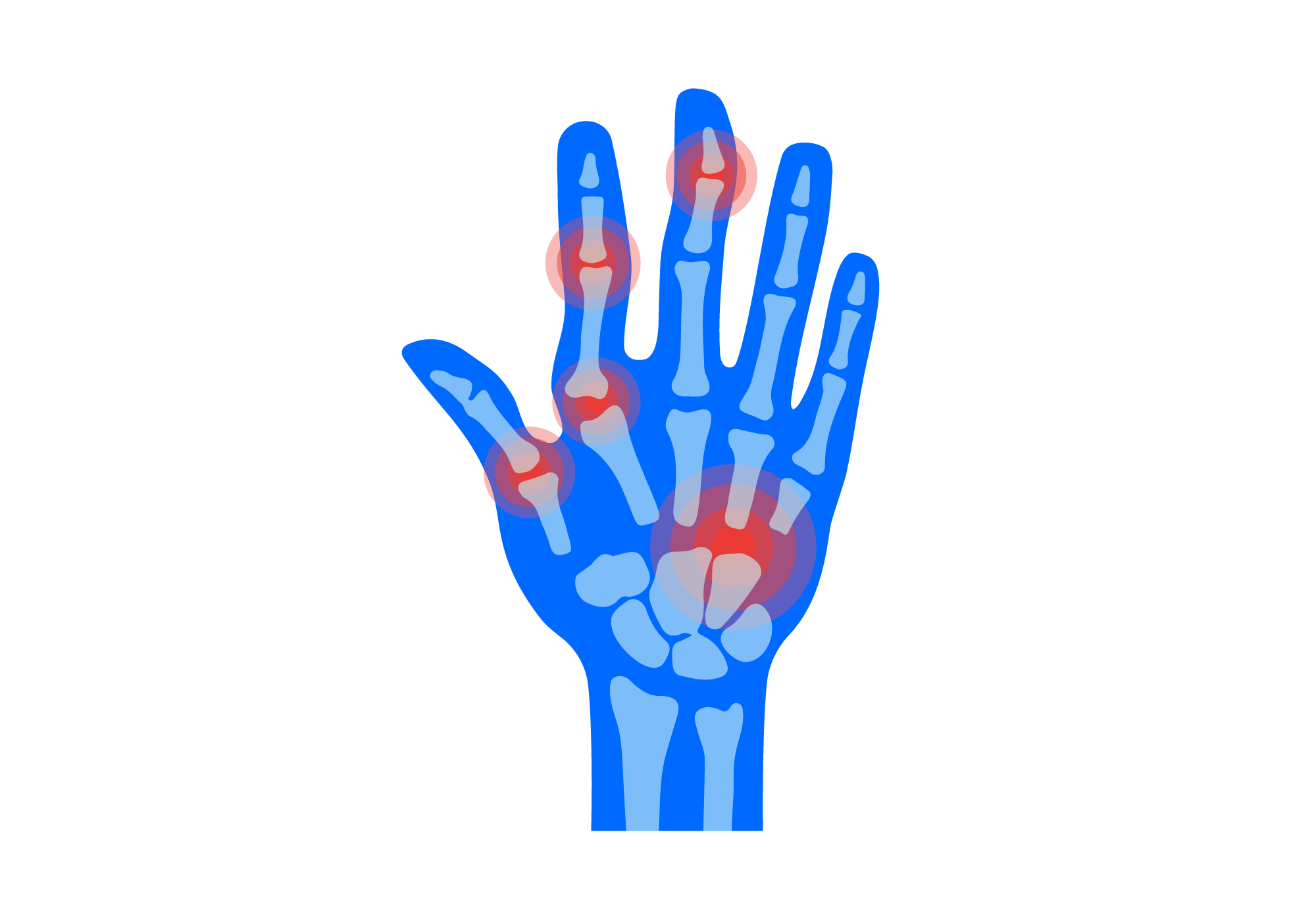 Rheumatoid Arthritis | What’s Causing Your RA & Treatment