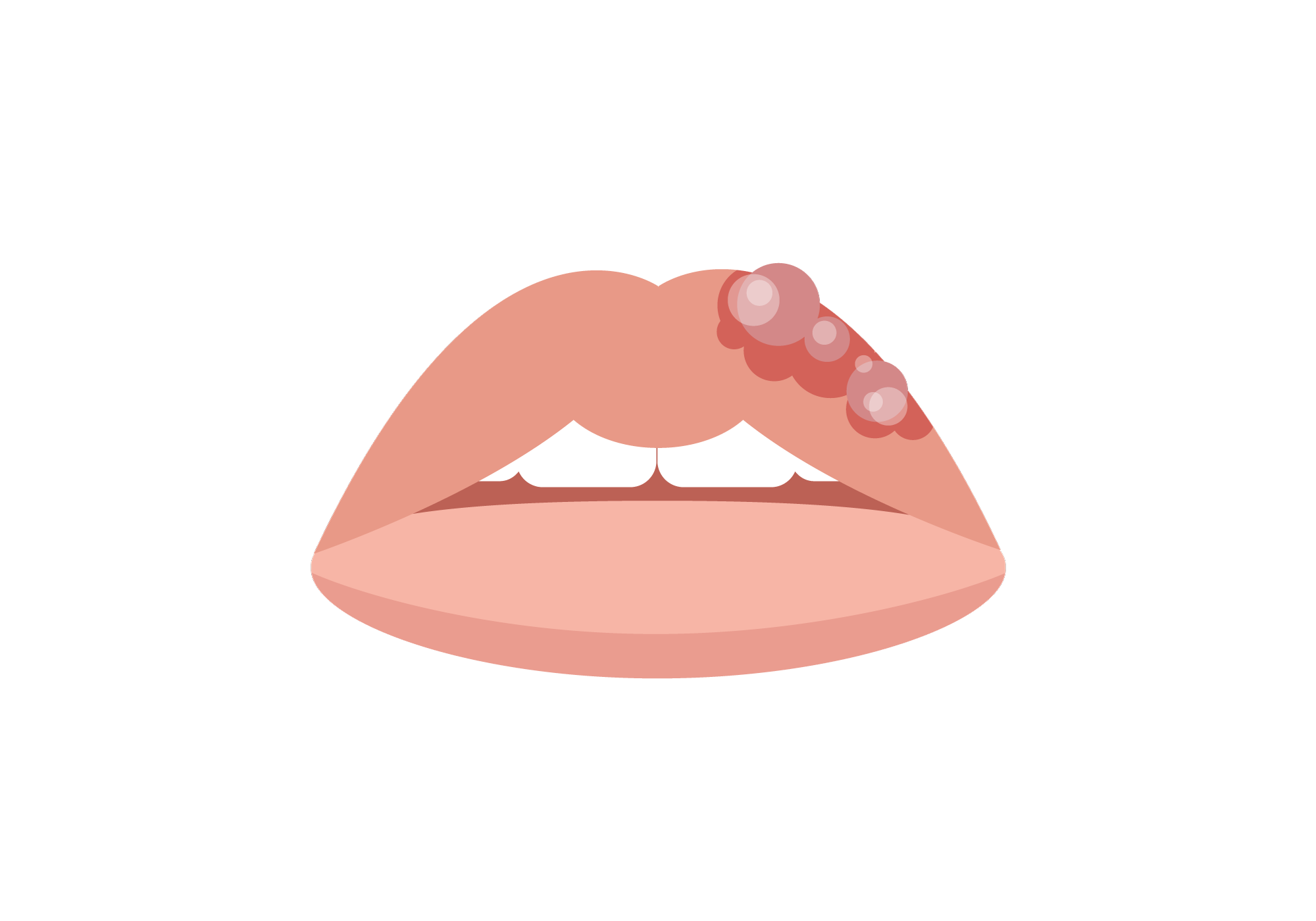 4 gatilhos comuns de herpes labial e tratamento rápido