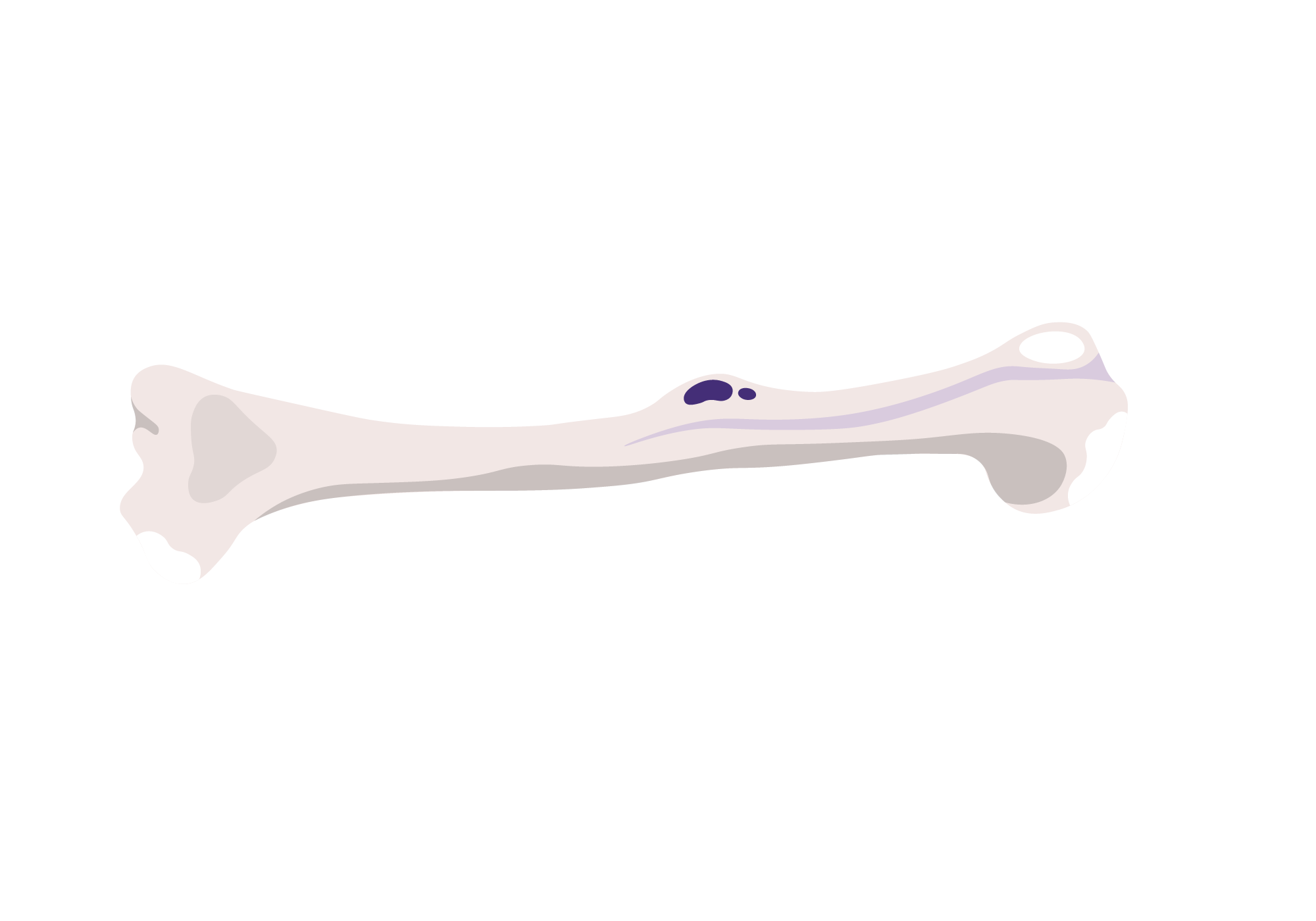 Osteoid Osteom | Gründe für Osteoid Osteom & Behandlung | Buoy